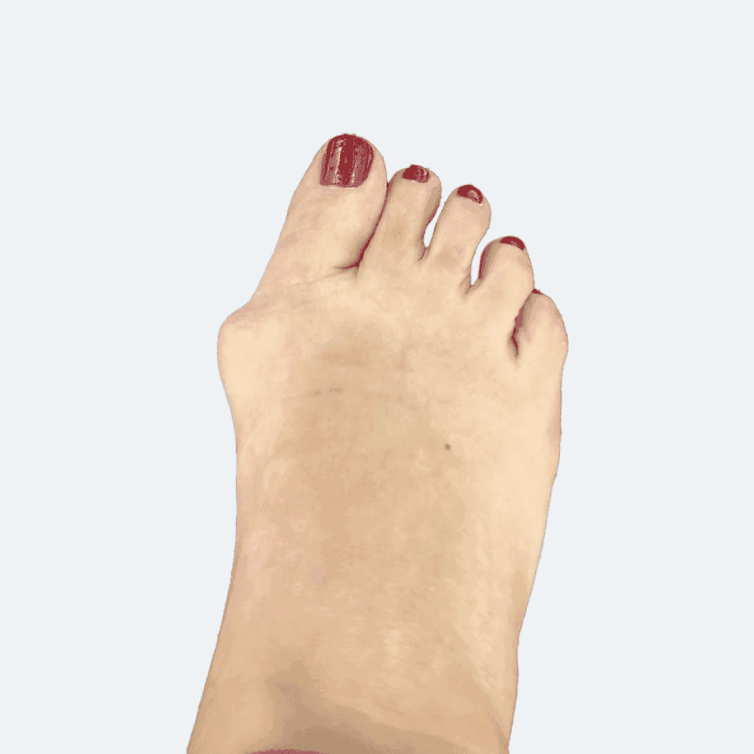 Bunyonlar Hakkında - Dr. Mugrabi Clinic