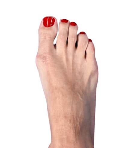 About Bunions - Dr. Mugrabi Clinic
