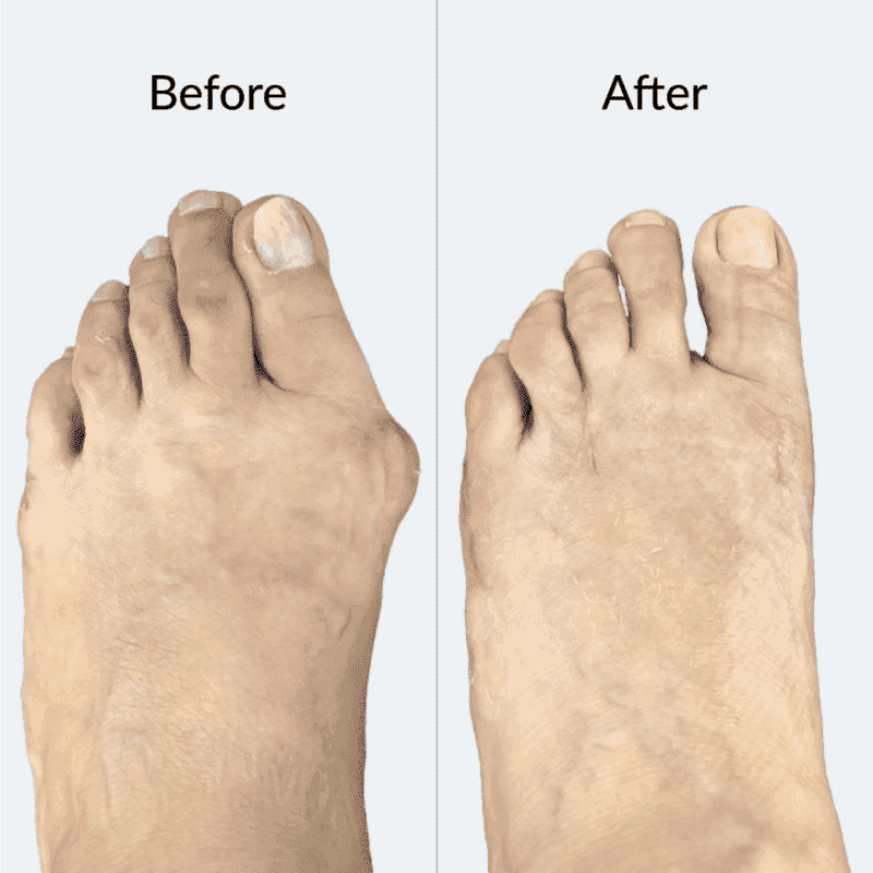 Dr Mugrabi Clinic Bunion Hallux Valgus