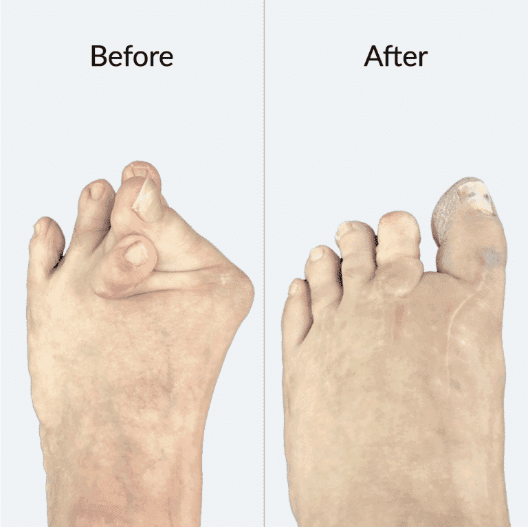 What Are the Causes of Morton's Neuroma? - Dr. Mugrabi Clinic