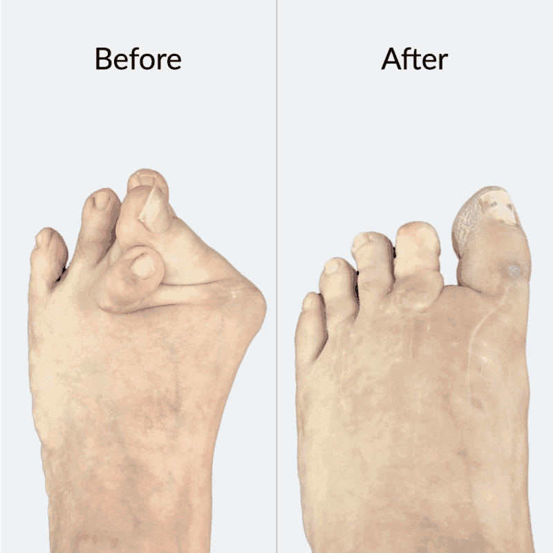 Wodurch wird das Morton-Neurom verursacht? - Dr. Mugrabi Clinic