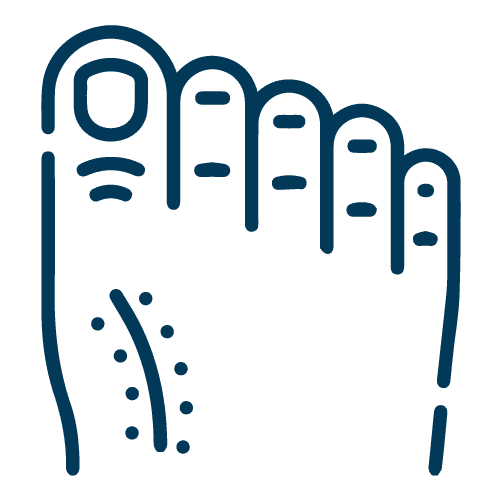 Minimally Invasive Bunion Correction - Dr. Mugrabi Clinic