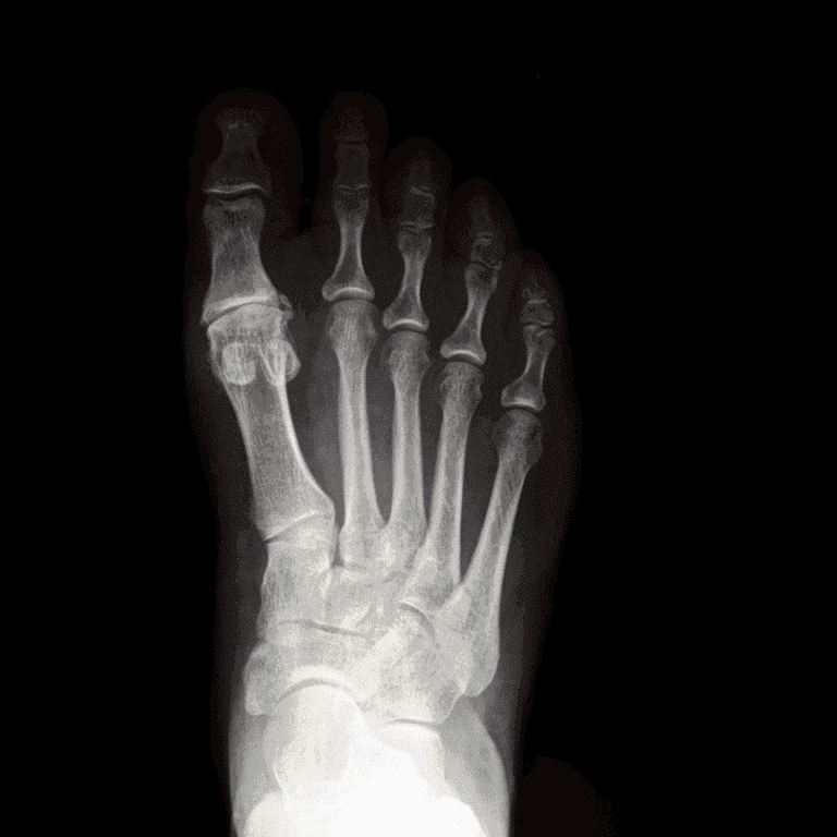 Hallux Rigidus - Dr. Mugrabi Clinic
